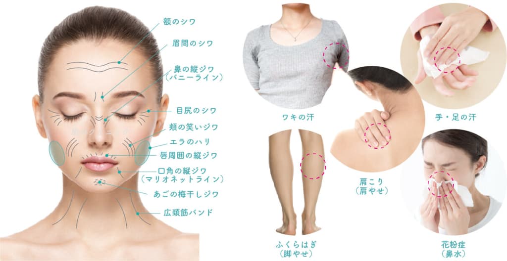 Botulinum toxin (BOTOX / CORETOX) Treatment | 肌のクリニック・高円寺院・麹町院 | 医療脱毛 ...