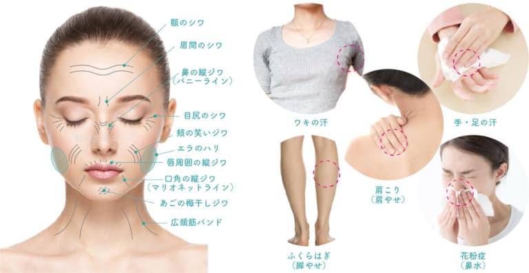 Botulinum toxin (BOTOX / CORETOX) Treatment | 肌のクリニック・高円寺院・麹町院 | 医療脱毛 ...